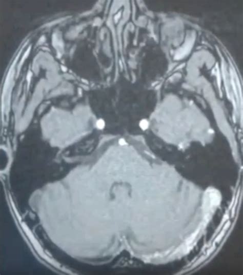 Hérnia De Uncus Sir Serviços E Residência Médica Em Radiologia