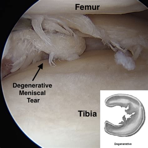 Degenerative Meniscus Tear Carolinas Pain Center Chronic Conditions
