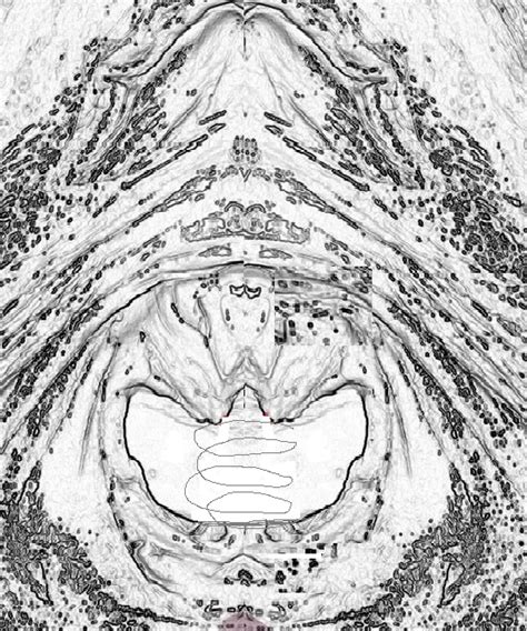Tightening Of The Vagina By Muscle Plication Download Scientific Diagram