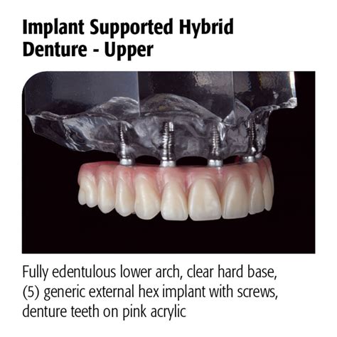 Implant Supported Hybrid Denture Upper Avtec Dental