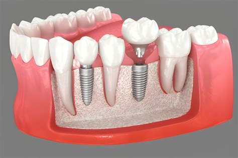 Dental Implants In Beverly Hills Ca Dental Implants Near Me
