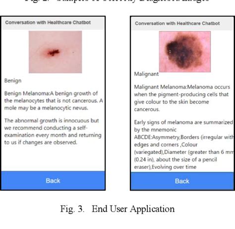 Figure 3 From Melanoma Detection Using Convolutional Neural Networks