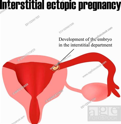 Development Of The Embryo In The Interstitial Department Ectopic