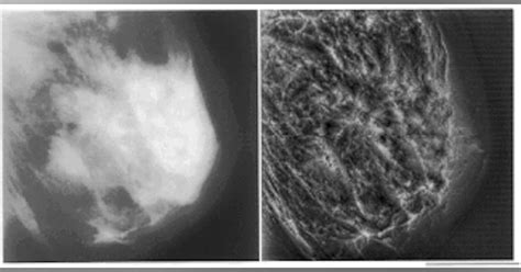 Wavelet Based Image Processing Enhances Mammography Laser Focus World