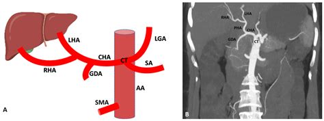 Hepatic Artery