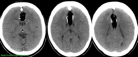 Dr Balaji Anvekar Frcr Intracranial Calcifications