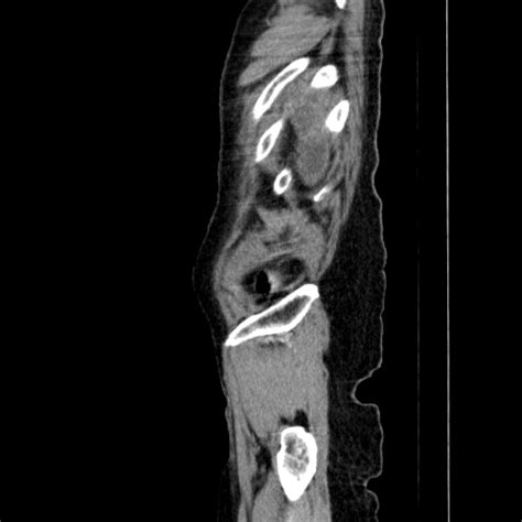 File Small Bowel Volvulus Causing Small Bowel Obstruction Mimicking Intussusception
