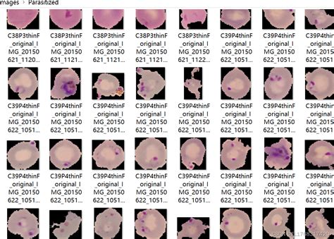 疟疾细胞感染分类数据集27560张2类别疟疾 数据集 Csdn博客
