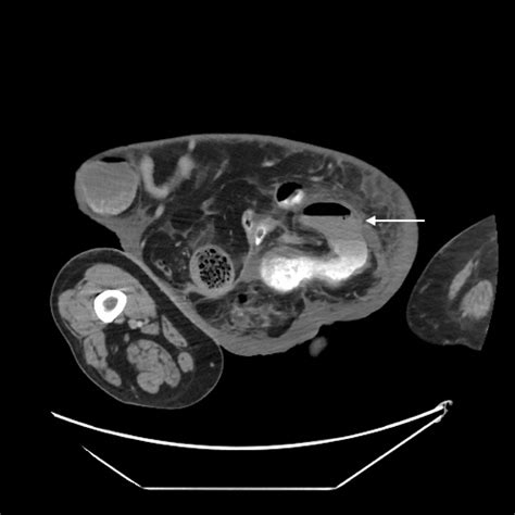 Large Ventral Hernia Axial Ct Annotated Jetem 2018 Jetem