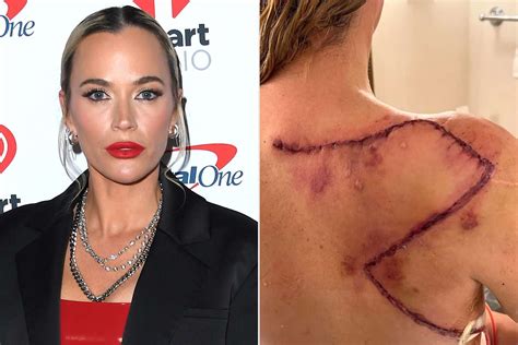 Teddi Mellencamp Reshares Graphic Image Of Surgery Scar For World Cancer Day
