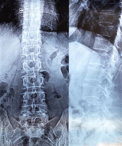 Vertical Image Of Lumbar Spine X Ray With Scoliosis Digital