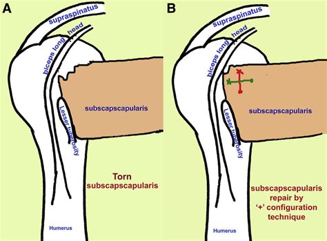 Left Shoulder In The Frontal View With The Subscapularis Tendon Download Scientific Diagram