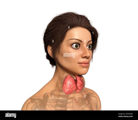 Thyrotoxic Goitre Goitre Illustration Goitre Swollen Neck Seen On A Woman Patient