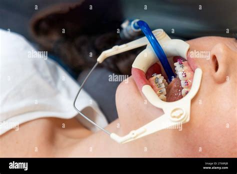 Close Up Top View Of Womans Mouth Wearing Ligature Braces Alignment