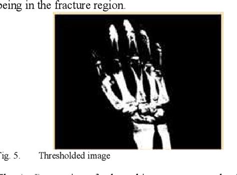 Figure 5 From Bone Fracture Detection And Classification Using Machine Learning Semantic Scholar