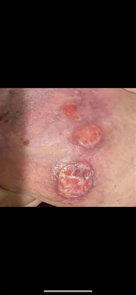 Pyoderma Gangrenosum On My Breast Rmakemesuffer