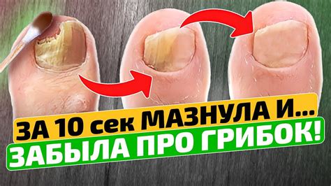Как избавиться от грибка стопы