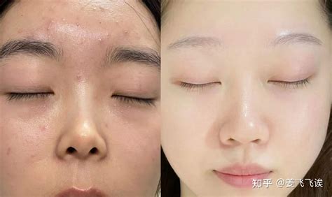 为什么丁香医生推荐皮肤粗糙、有细纹时，刷好a酸就可以去除？真的那么有效、不烂脸吗？ 知乎