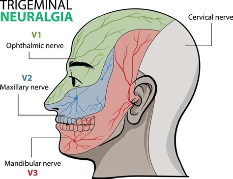 Trigeminal Neuralgia Trigger Points