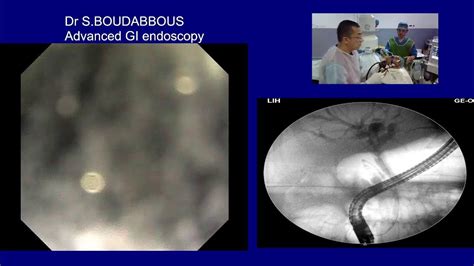 Ercp For Acute Cholangitis Youtube
