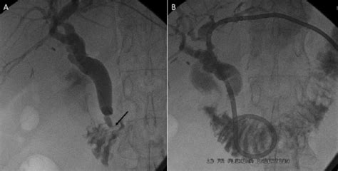 Left Sided Internal External Percutaneous Transhepatic Biliary Drainage