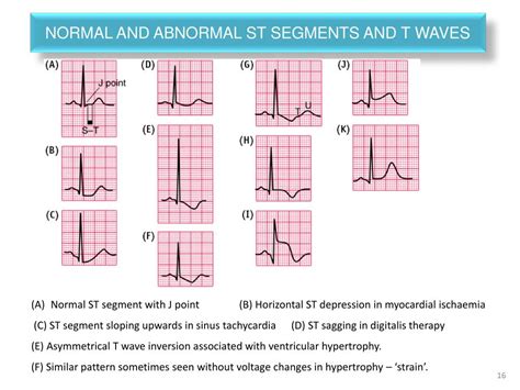 Ppt Electrocardiogram Ecg Iii Powerpoint Presentation Free Download