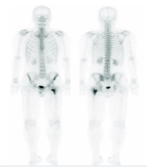 Technetium Scintigraphy Tc 99m Mdp [methylene Diphosphonate] After Download Scientific
