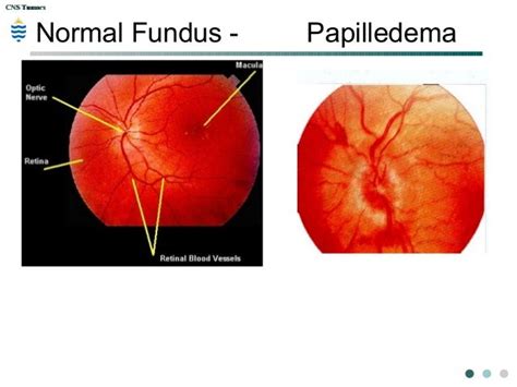 Papilledema Vs Normal
