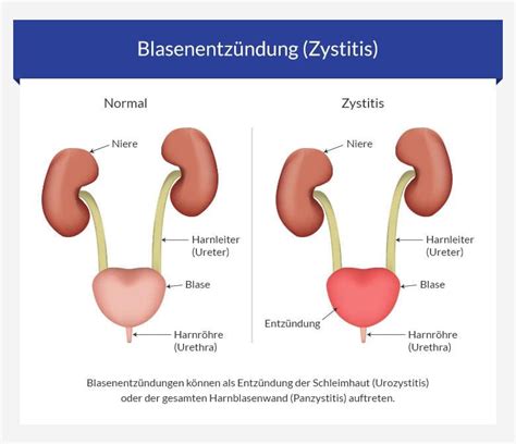 Staphylokokken Zystitis Bilder Staphylokokken Infektion Bilder Vnums