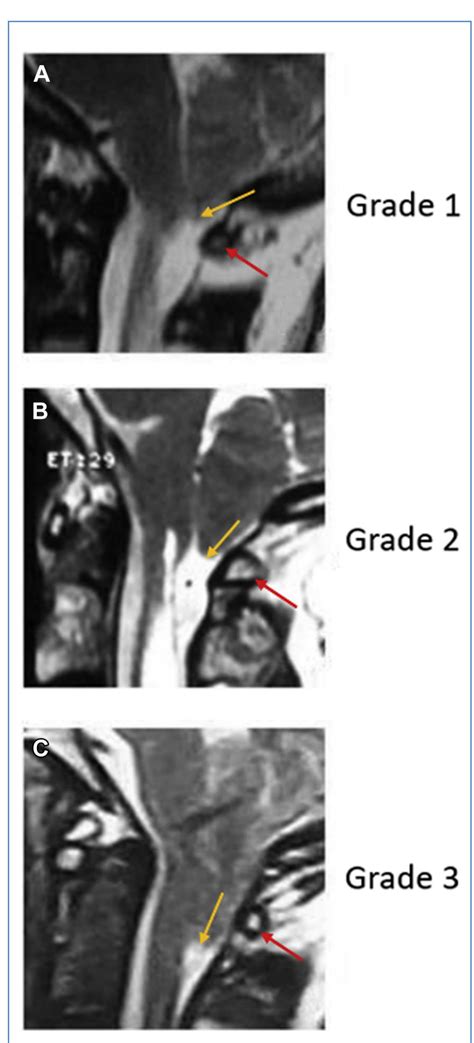 Pdf Adding Expansile Duraplasty To Posterior Fossa Decompression May