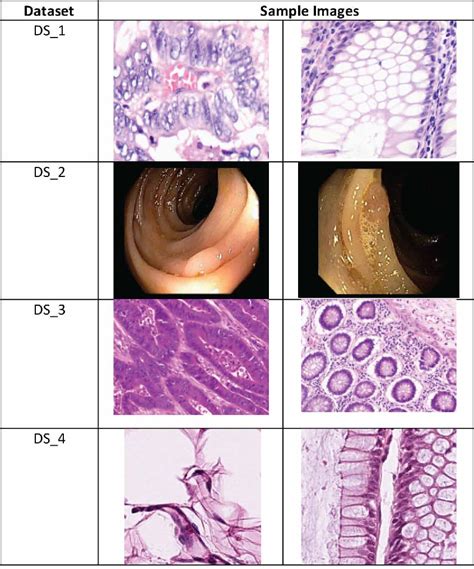 Table 2 From Automated System For Colon Cancer Detection And Segmentation Based On Deep Learning
