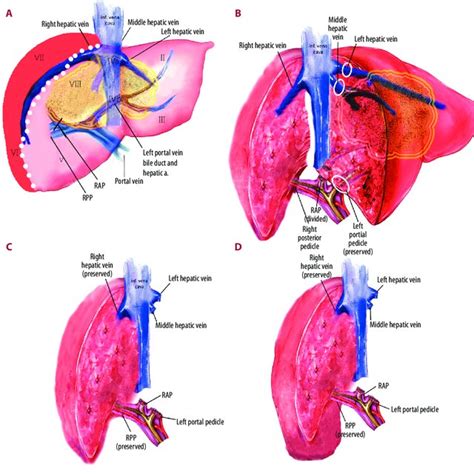 Pdf First Left Hepatic Trisectionectomy Including Segment One With New Associated Liver