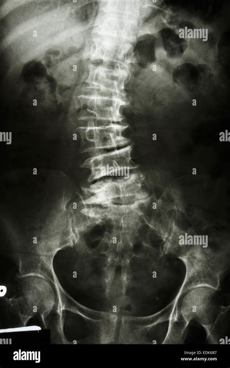 Scoliosis Film X Ray Lumbar Spine AP Show Spine Bend In Old Aged