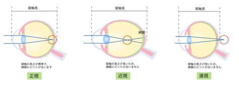 弱視 Hoya株式会社