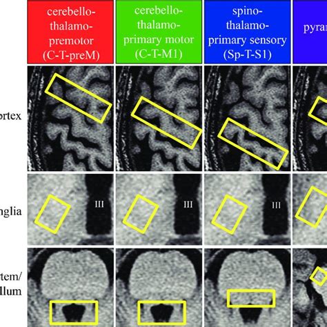 Ftm Tremor Rating Scale Three Items Of The Ftm Tremor Rating Scale Ue Download Scientific