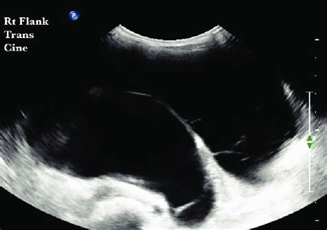 Abdominal Ultrasound Showing Csf Pseudocyst Download Scientific Diagram