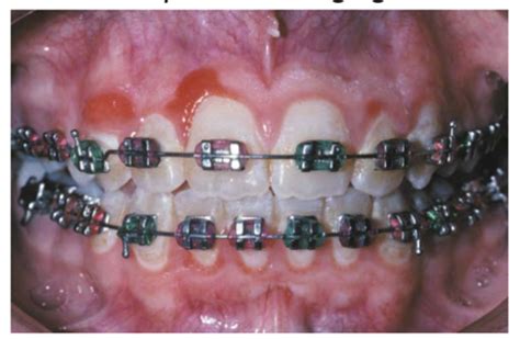 Perio Classification Of Disease Part 1 Flashcards Quizlet