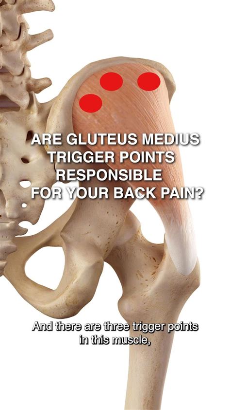 Are Trigger Points In The Gluteus Medius Responsible For Your Back Pain Video Trigger