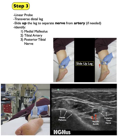 Tibial Highland EM Ultrasound Fueled Pain Management