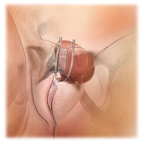 Mesh Mid Urethral Slings Your Pelvic Floor