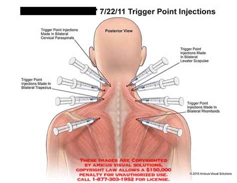 Levator Scapula Trigger Point Map Health Myofascial