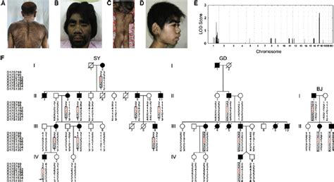 Phenotypes And Genetic Mapping Of Congenital Generalized Hypertrichosis Download Scientific