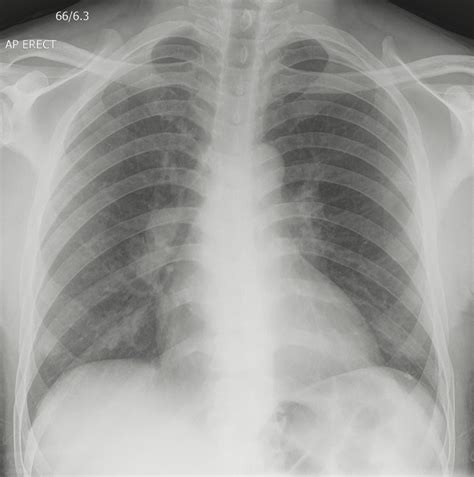 A Diffuse Fine Papular And Pustular Rash In A Man With Advanced Human