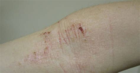 Center Of Excellence For Skin And Allergy Research Chulalongkorn University ผลการรักษาด้วยยา