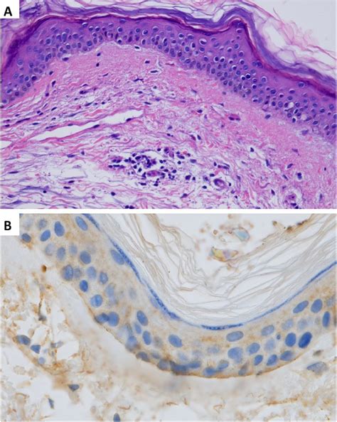Leukocytoclastic Vasculitis In Association With Linear Epidermal
