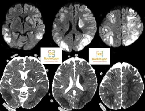 Meningioma Radiology Case Radiogyan