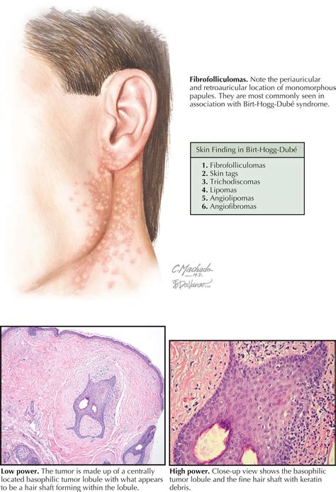 Benign Growths Clinical Tree