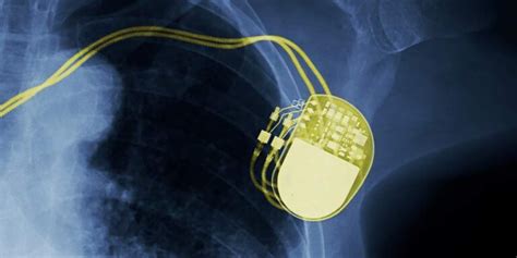 Mri With Pacemaker Is It Safe • American Health Imaging