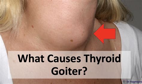 Thyroid Goiter Heres What Caused It And How To Stop It From Growing