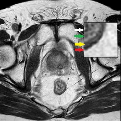 Figure 3 From Mri Evaluation Of Rectal Anatomy Semantic Scholar